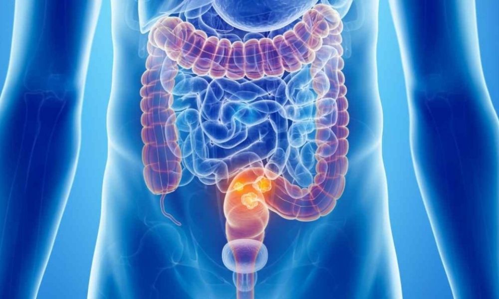 Rektum Kanseri Sebepleri - Mehmet Çağlıkülekçi